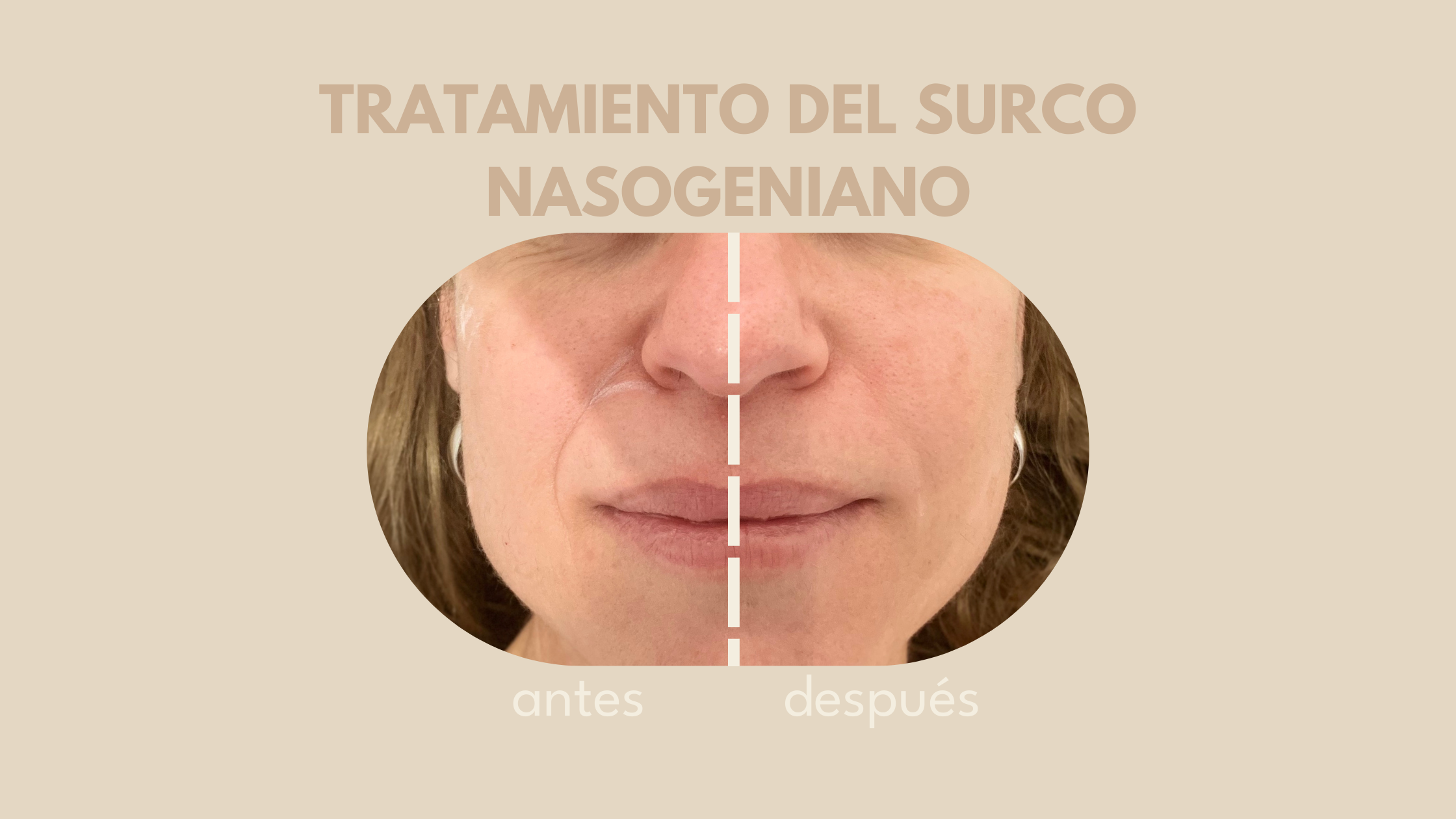 Tratamiento del surco nasogeniano Tratamiento del surco nasogeniano